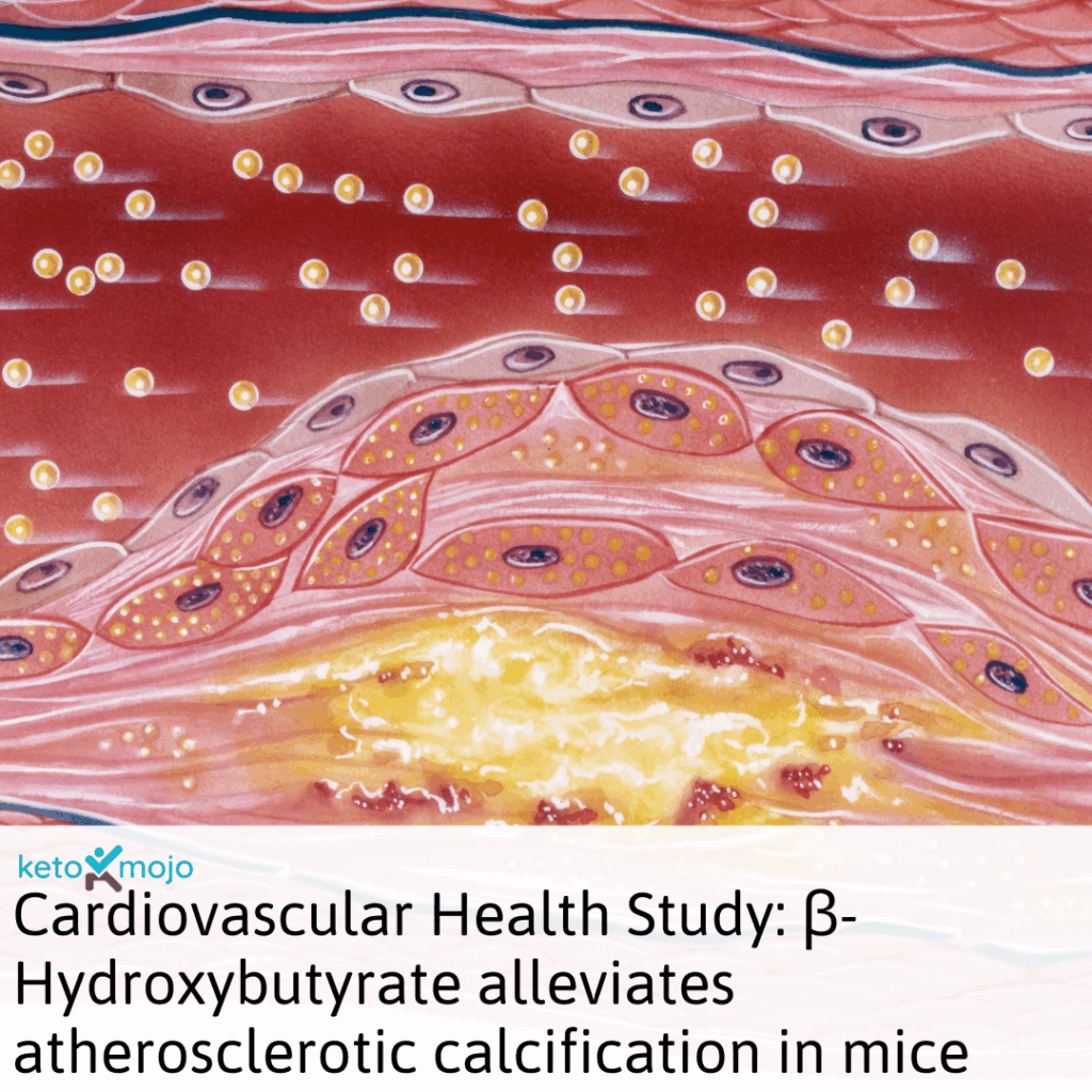 β-Hydroxybutyrate Alleviates Atherosclerotic Calcification by ...